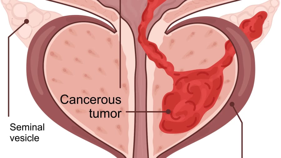 Prostate & Urologic Cancers Program > Departments > Yale Medicine