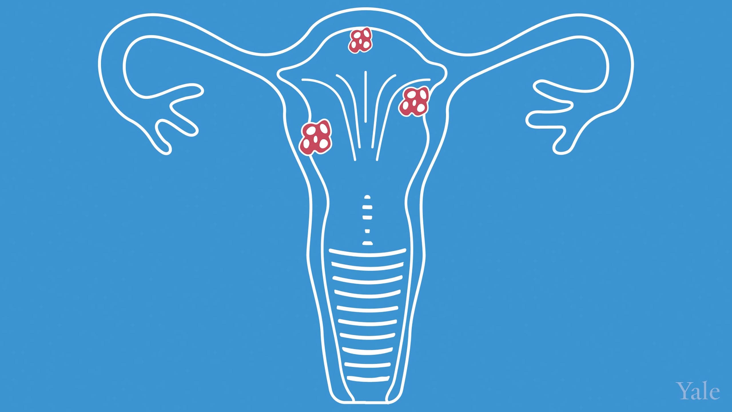 Uterine Fibroid Embolization > Fact Sheets > Yale Medicine