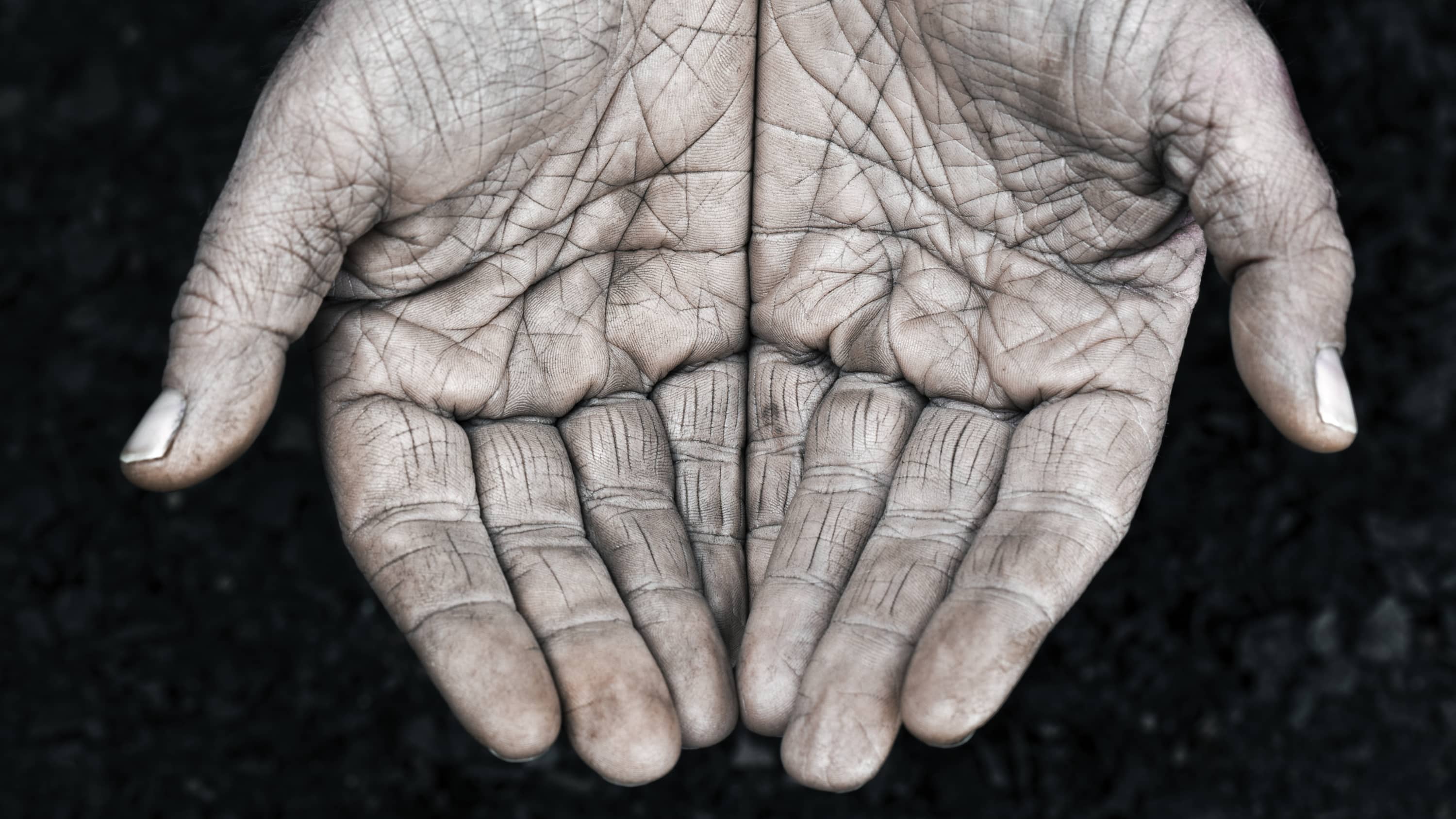 Dupuytren's Contracture > Fact Sheets > Yale Medicine