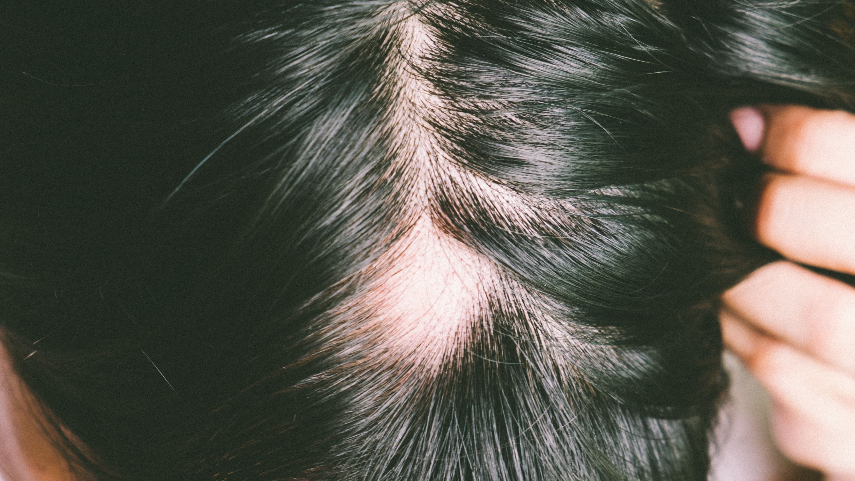 Alopecia Areata > Fact Sheets > Yale Medicine
