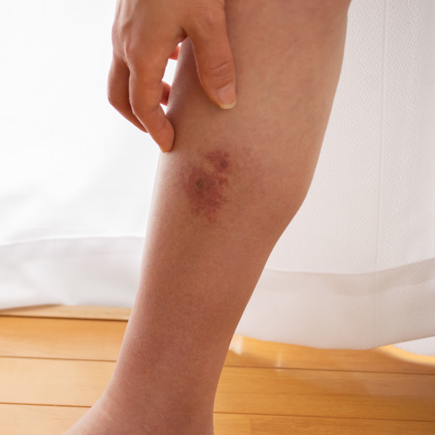 Shingles Symptoms On Legs
