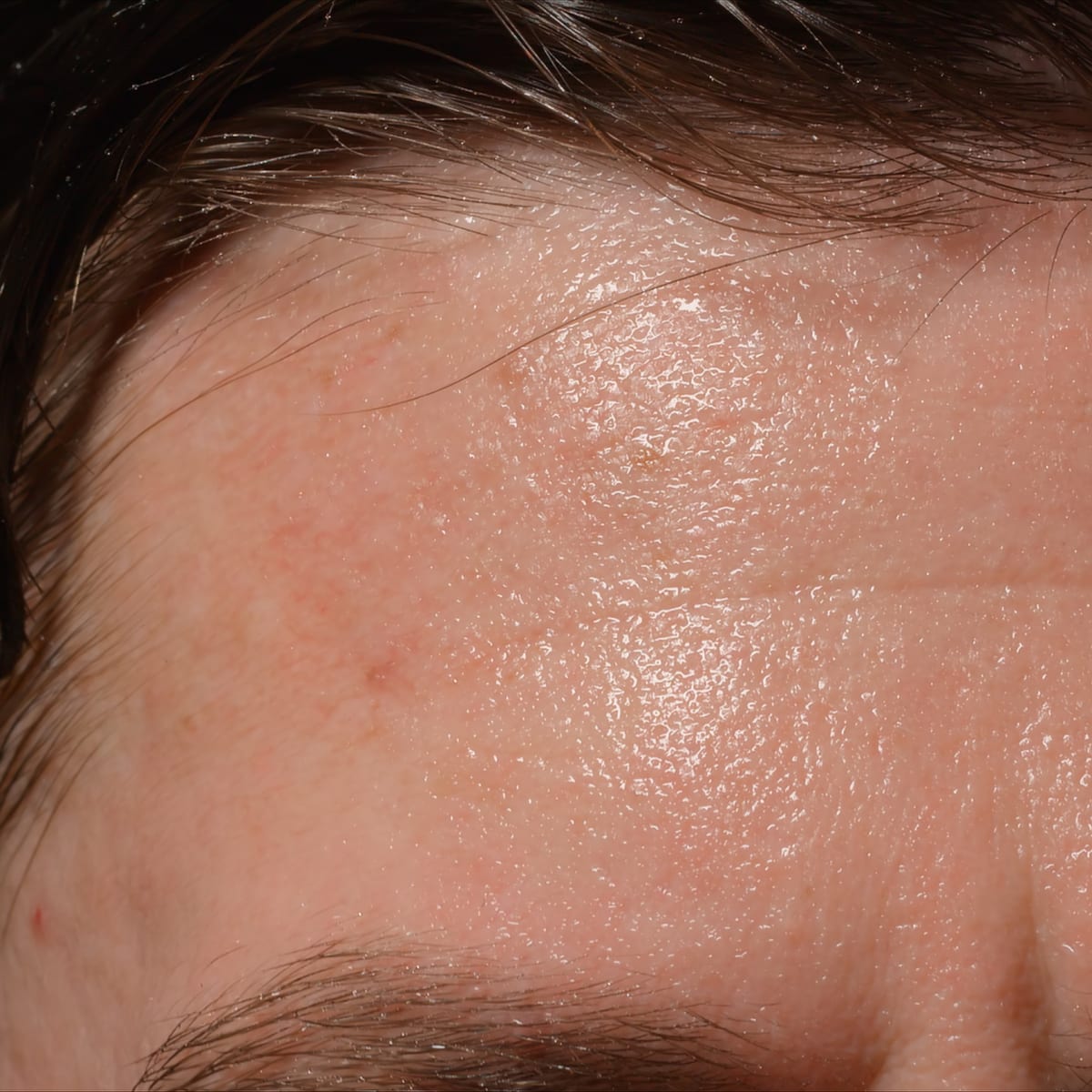 sweating forehead after eating