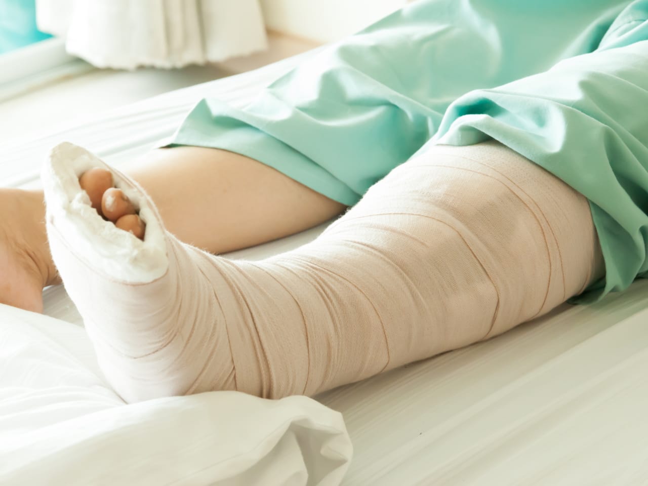 compound complex fracture