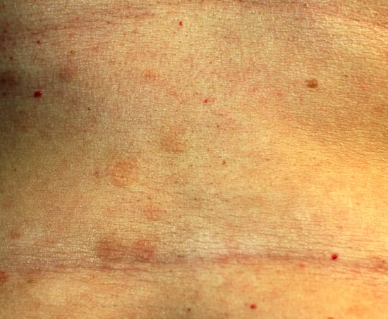 lace pattern rash