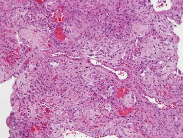 Lung Fibrosis and Repair | Pulmonary, Critical Care and Sleep Medicine