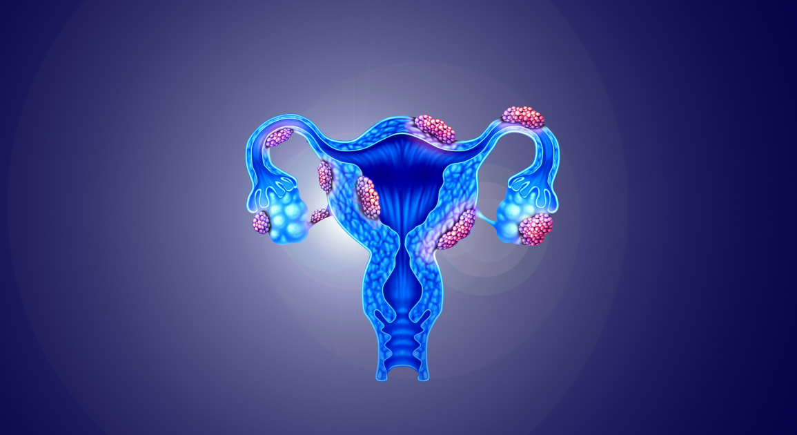 Promising Trial for a Drug to Ease Uterine Fibroids | Yale School of ...
