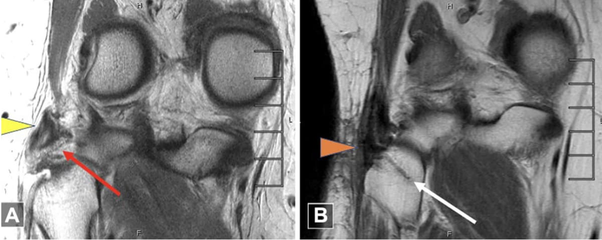 Repair of Acute Grade 3 Combined Posterolateral Corner Avulsion ...