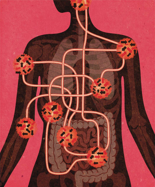 Untangling the Web of Autoimmune Diseases | Yale School of Medicine