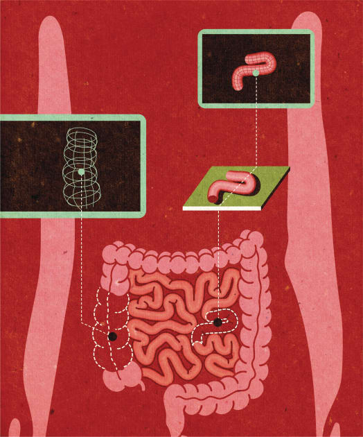 A new dimension to intestinal surgery