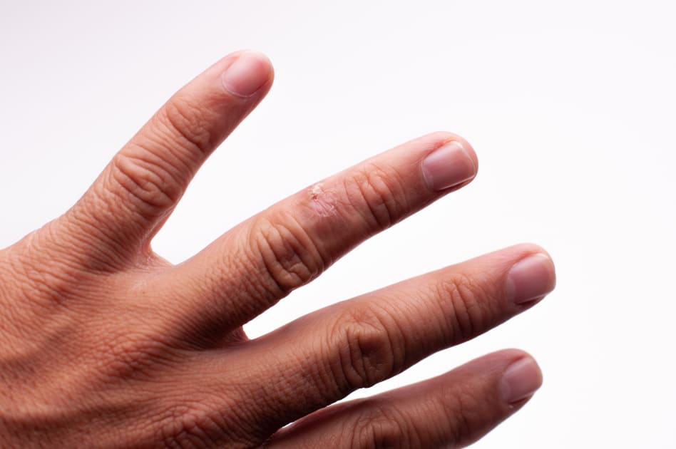 Four Things To Know About Scleroderma | Yale School of Medicine