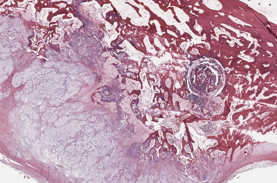 Yale Bone and Soft Tissue Pathology | Pathology