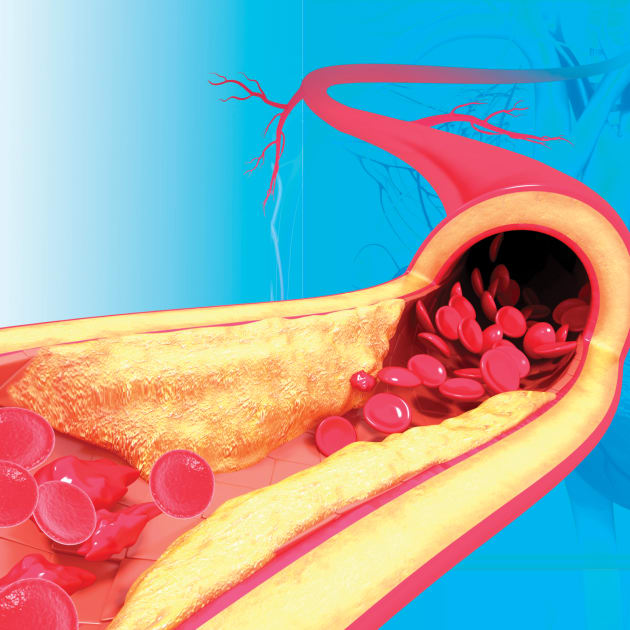 Researchers Discover Potential Therapeutic for Incurable Vascular ...