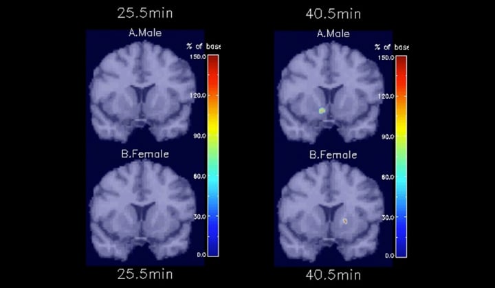 Smoking lights up brain’s response differently in men and women
