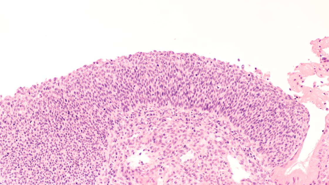 Topical Shows Promise in Treating Precancerous Cervical Condition ...