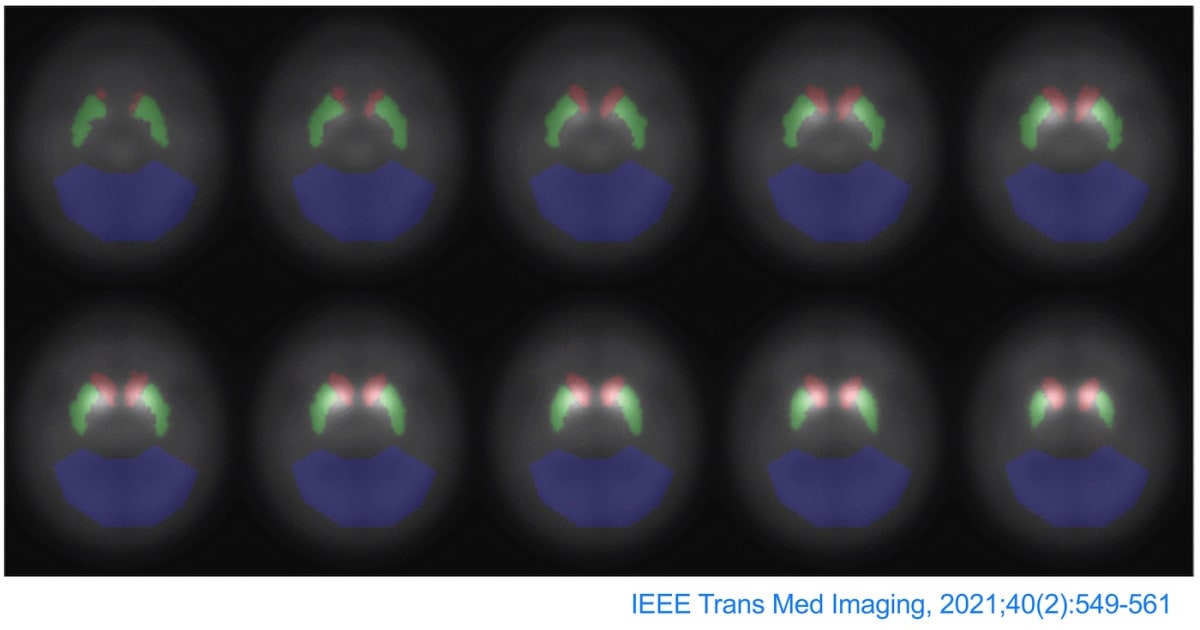 Dopamine Transporter Scan-Based Disease Progression Models for Early ...