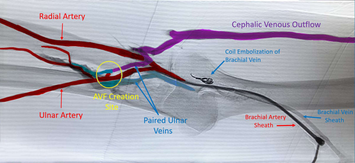 Interventional Radiologists Perez Lozada and Marino Create First ...