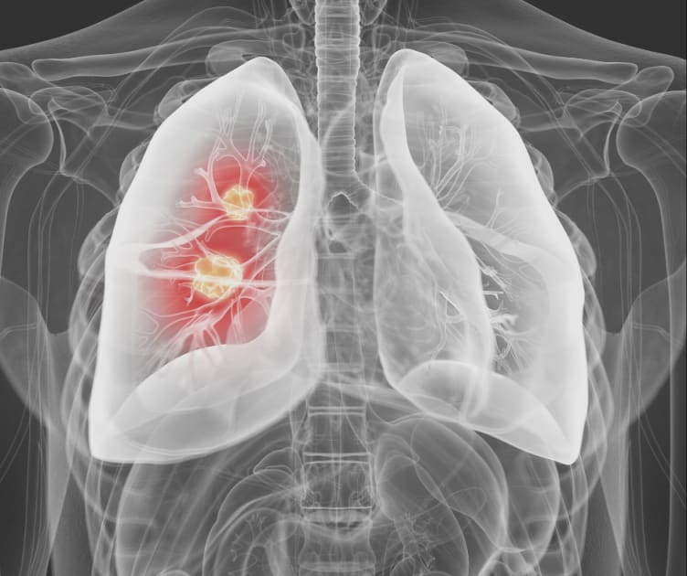 ADAURA Trial Results Provide New Hope for Patients with Early-Stage Non ...