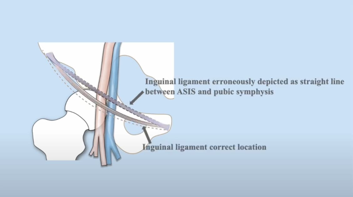 New Instructional Video on Optimal Femoral Access Corrects Anatomical ...