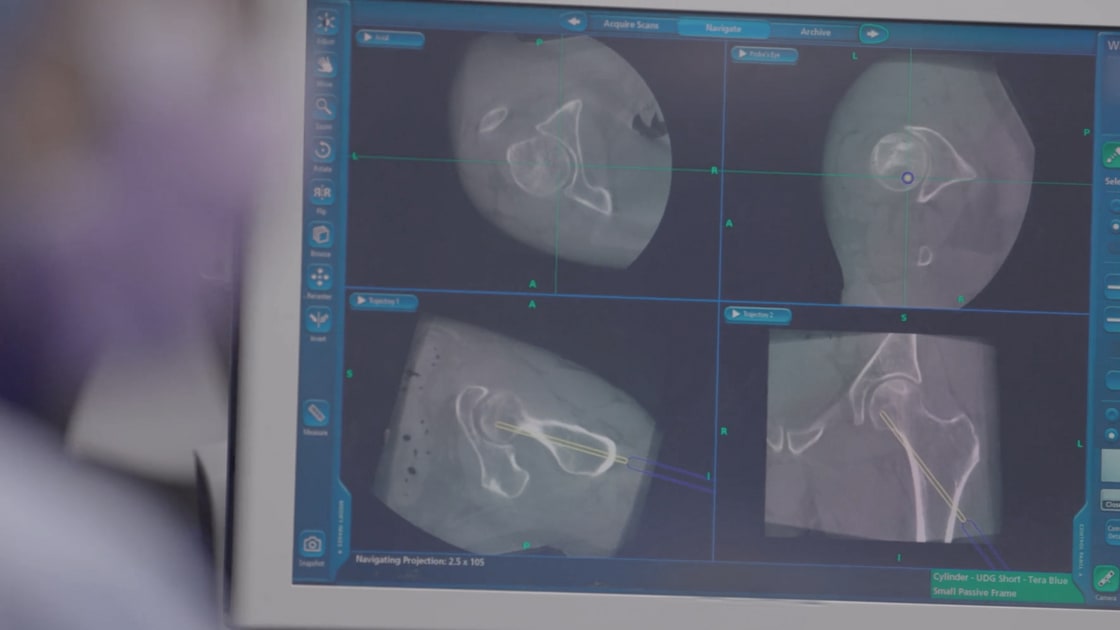 Avascular Necrosis | Orthopædics & Rehabilitation
