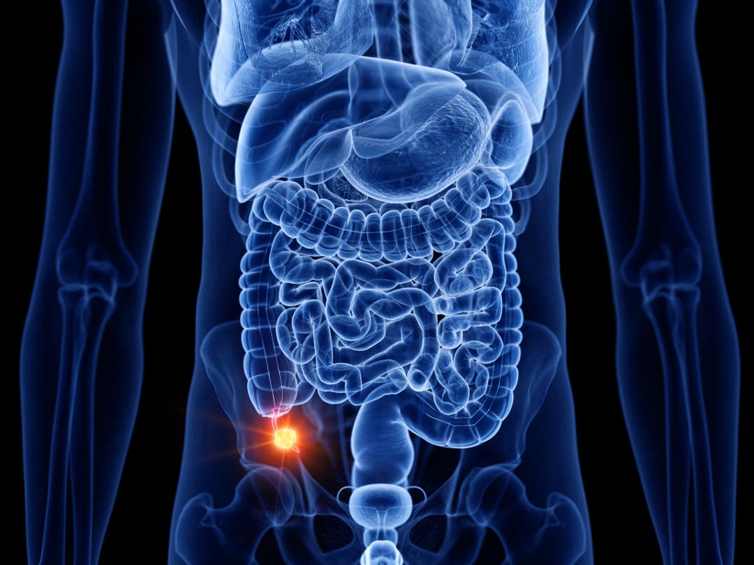 From Symptoms to Survival: What to Know About Appendix Cancer | News ...