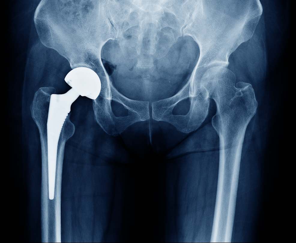 Planning a Hip Replacement? 6 Things to Know | News | Yale Medicine