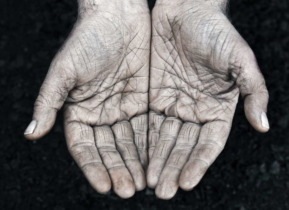 Hand Ischemia: When Hand Pain Won’t Go Away | News | Yale Medicine