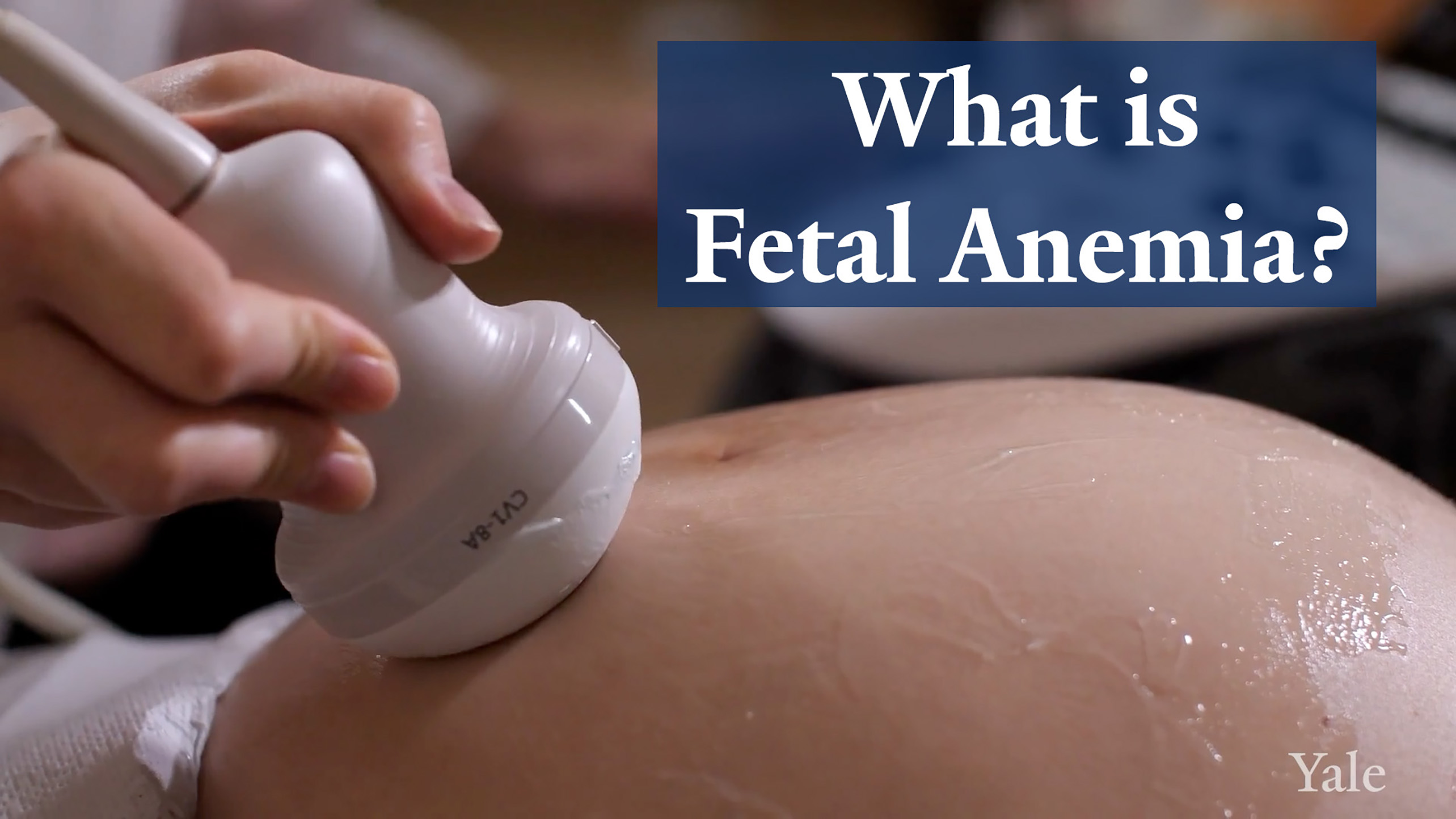 How Fetal Anemia Is Diagnosed and Monitored | News | Yale Medicine