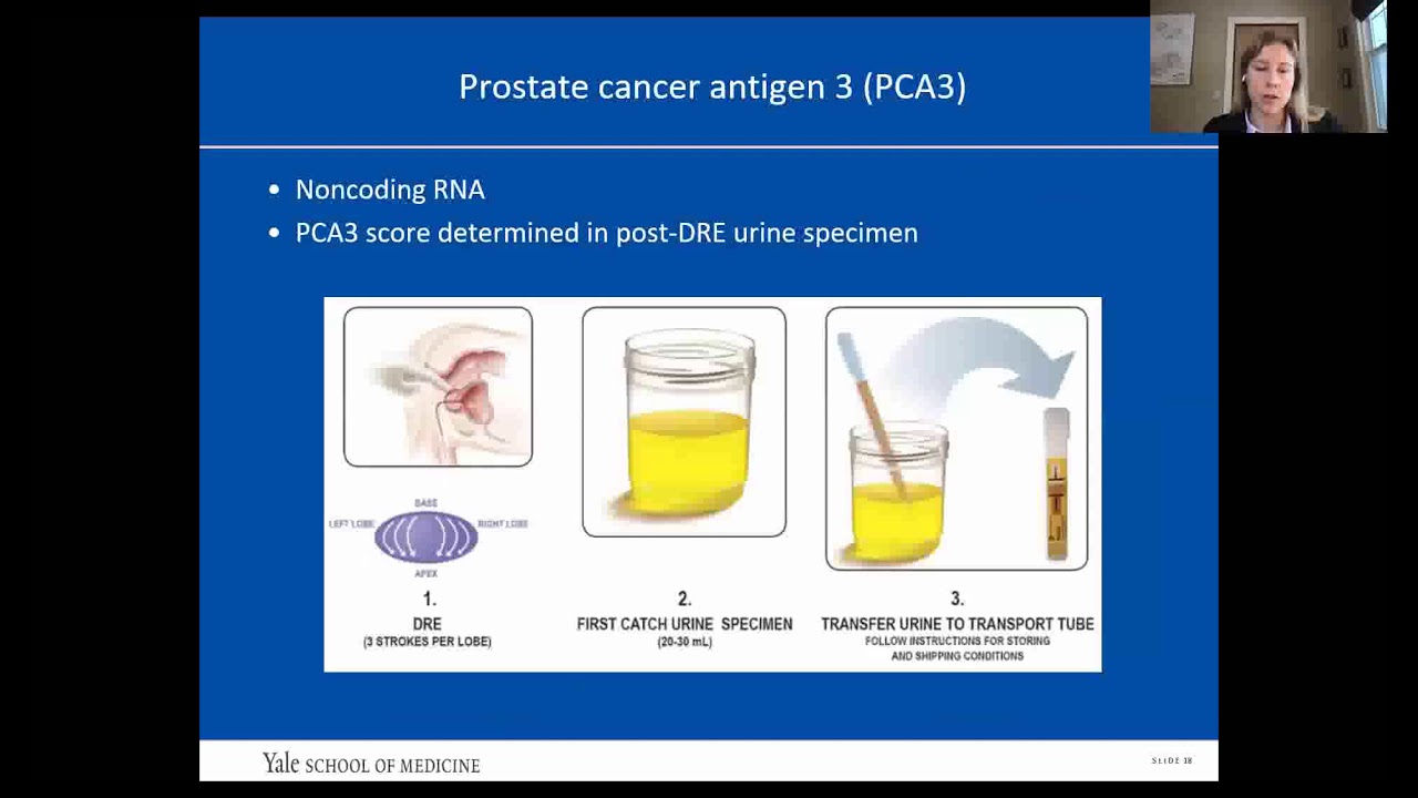 “Biomarkers in Prostate Cancer” and “Treatment Strategies for Locally ...