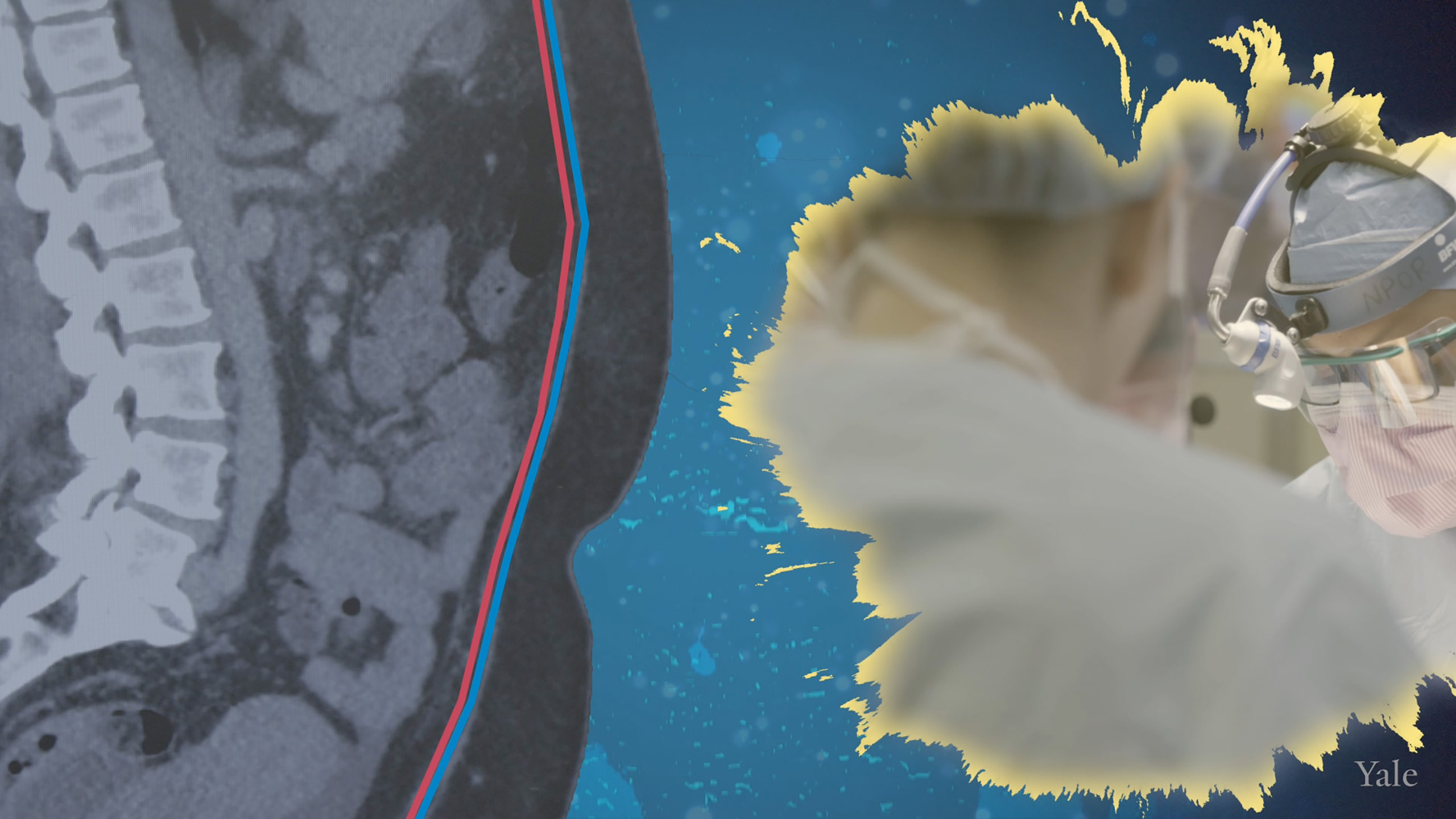 How HIPEC Surgery Treats Abdominal Cancers > News > Yale Medicine