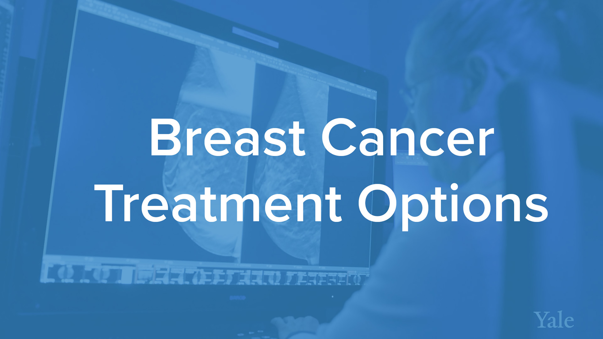 Navigating Treatment Options for Breast Cancer > News > Yale Medicine