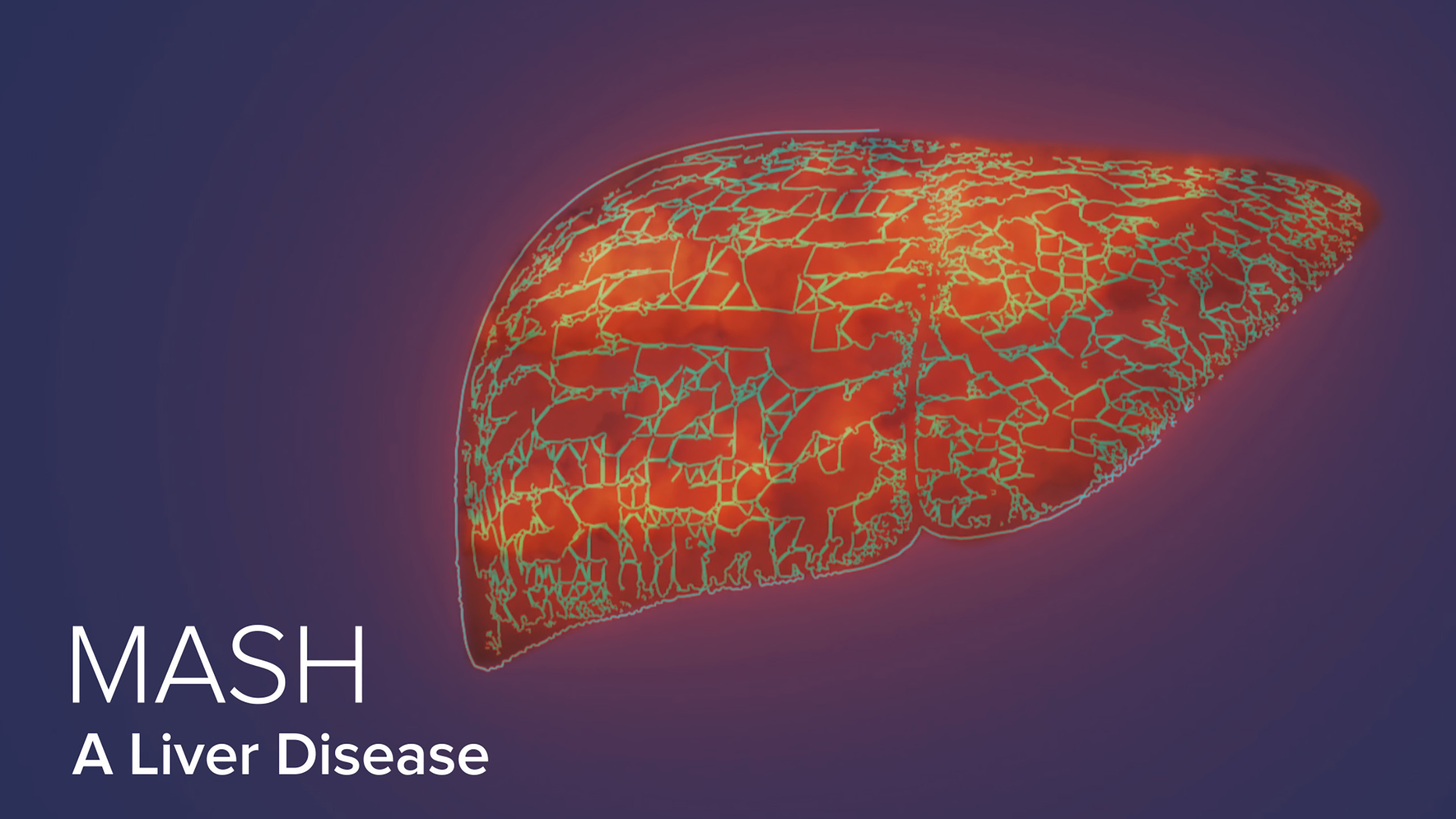 MASH (Formerly NASH): Understanding This Form of Fatty Liver Disease > News > Yale Medicine