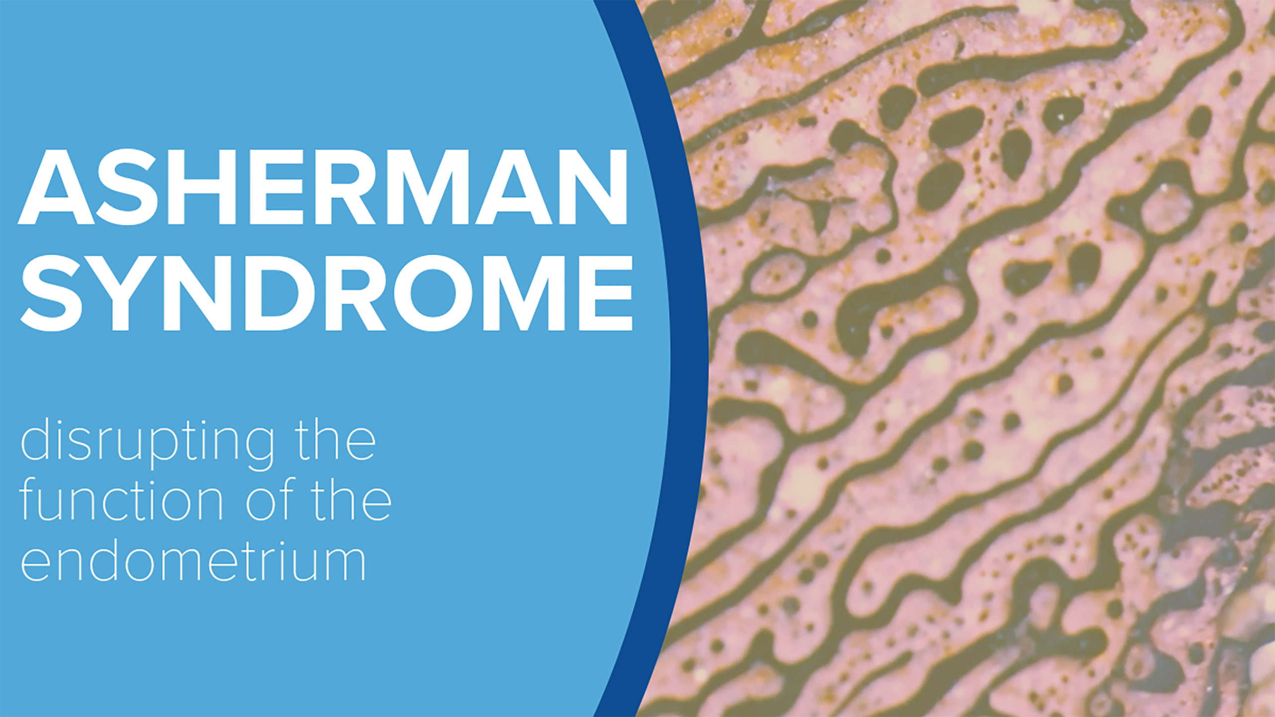 How Asherman Syndrome Impacts Fertility | News | Yale Medicine